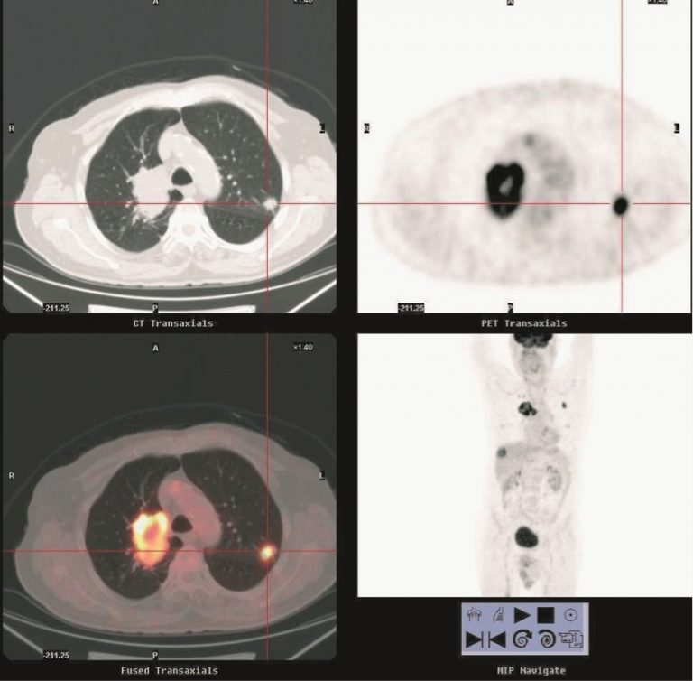 ¿Qué es una PET-TAC?