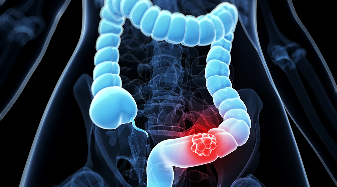 Cáncer de colon