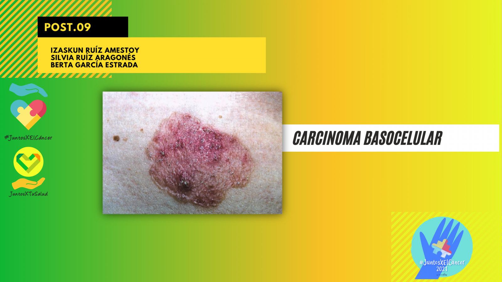 Carcinoma basocelular
