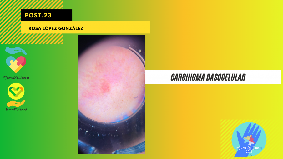 Carcinoma basocelular